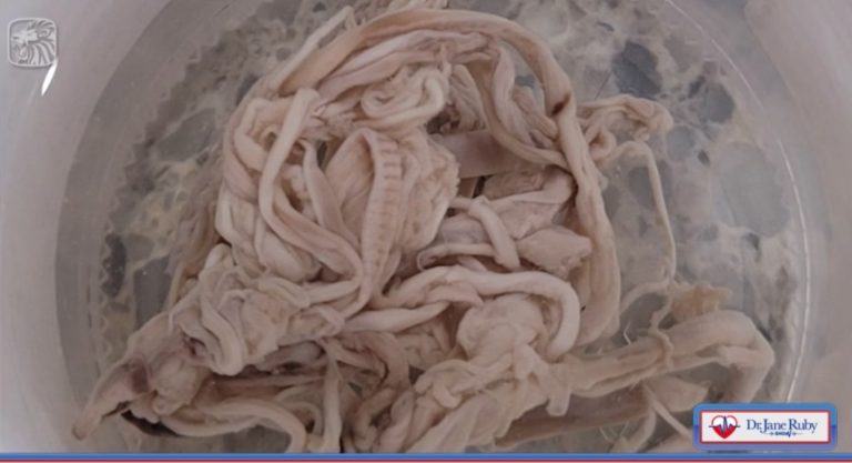 Scientist Confirms White Clots Caused by Shots Are Infectious Amyloid ...